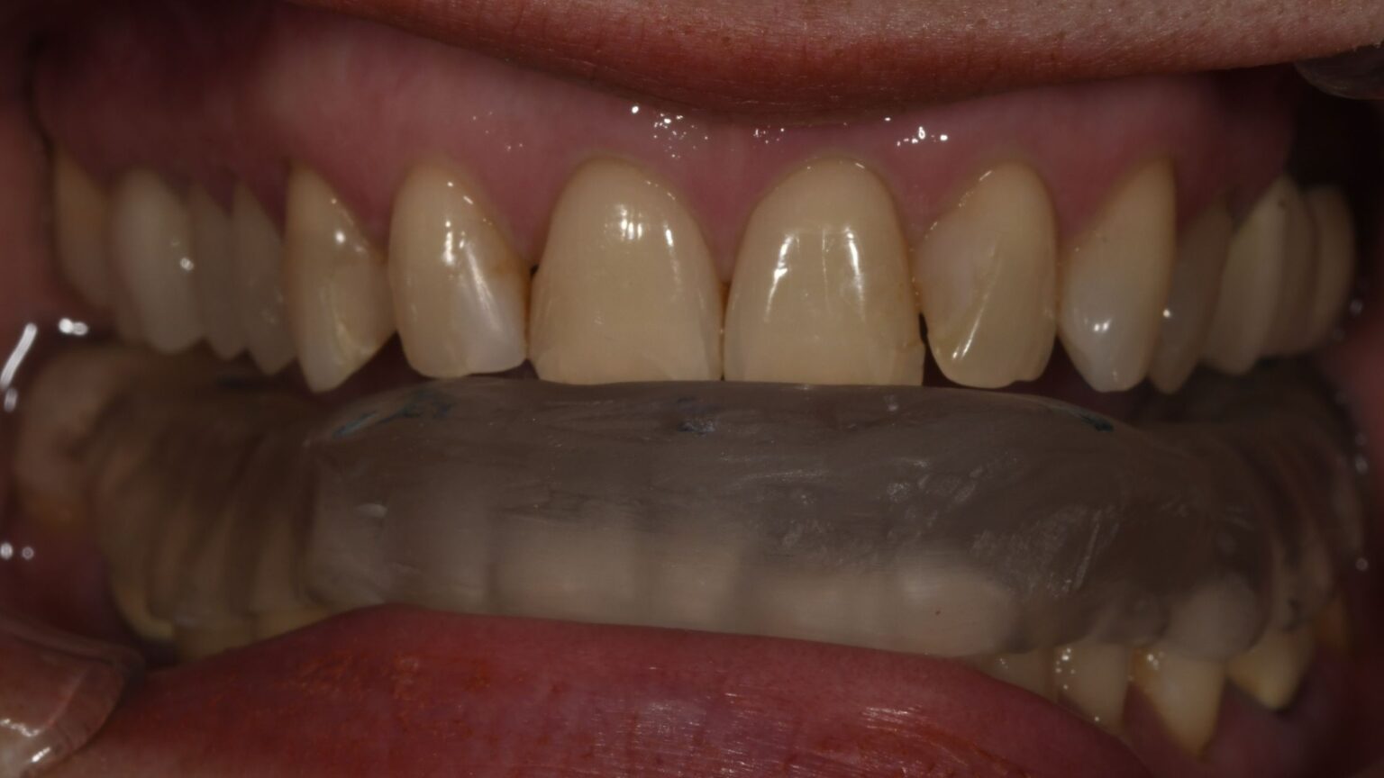 How to Stop Grinding Your Teeth (A Guide to Grinding Splints) | Smile ...